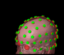 HD-tDCS – High-Definition Transcranial Direct Current Stimulation ...